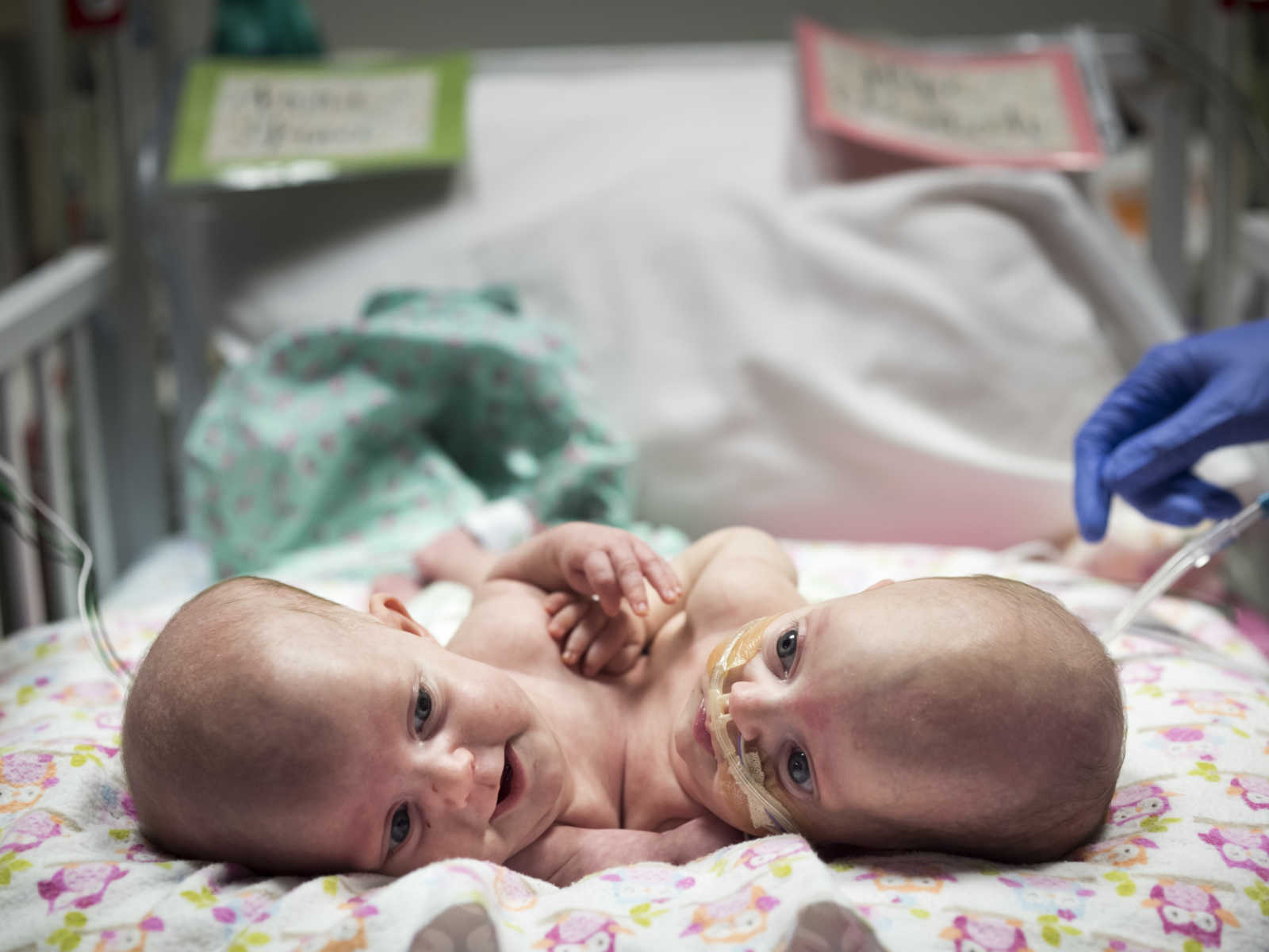 Parents Celebrate Formerly Conjoined Twins After Successful Surgery ...