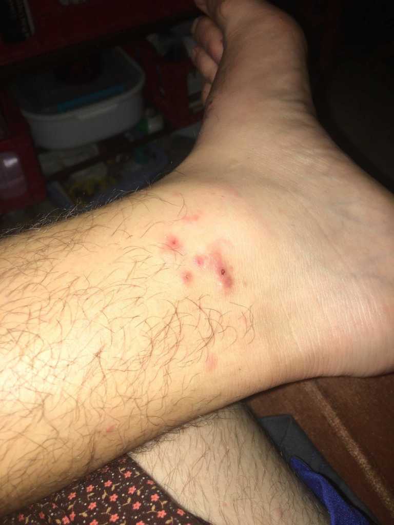 My Son Got A Severe Parasite Infection From Being Buried In The Sand At ...
