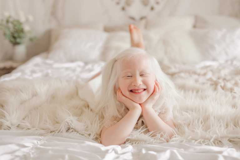 ‘Life with four children with albinism has been quite the adventure ...