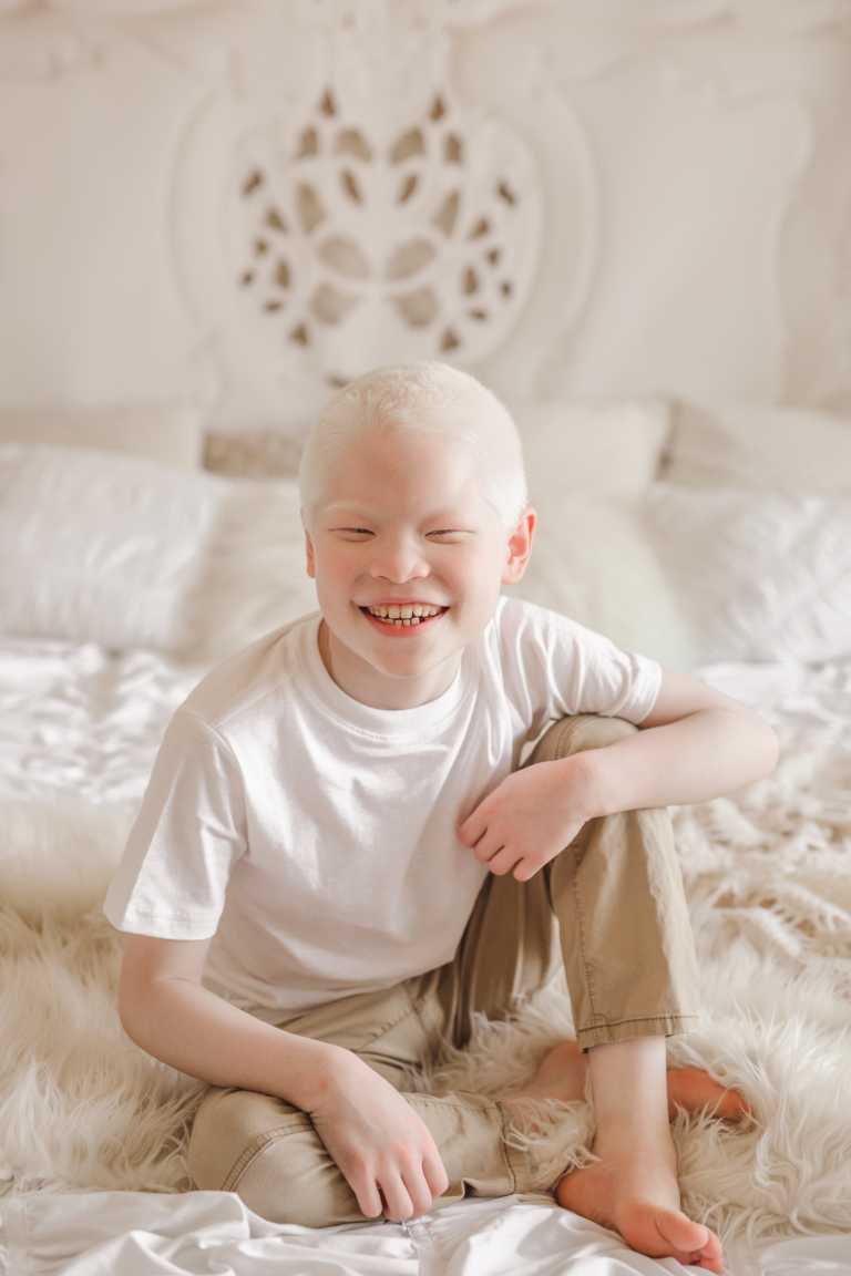 ‘Life with four children with albinism has been quite the adventure ...