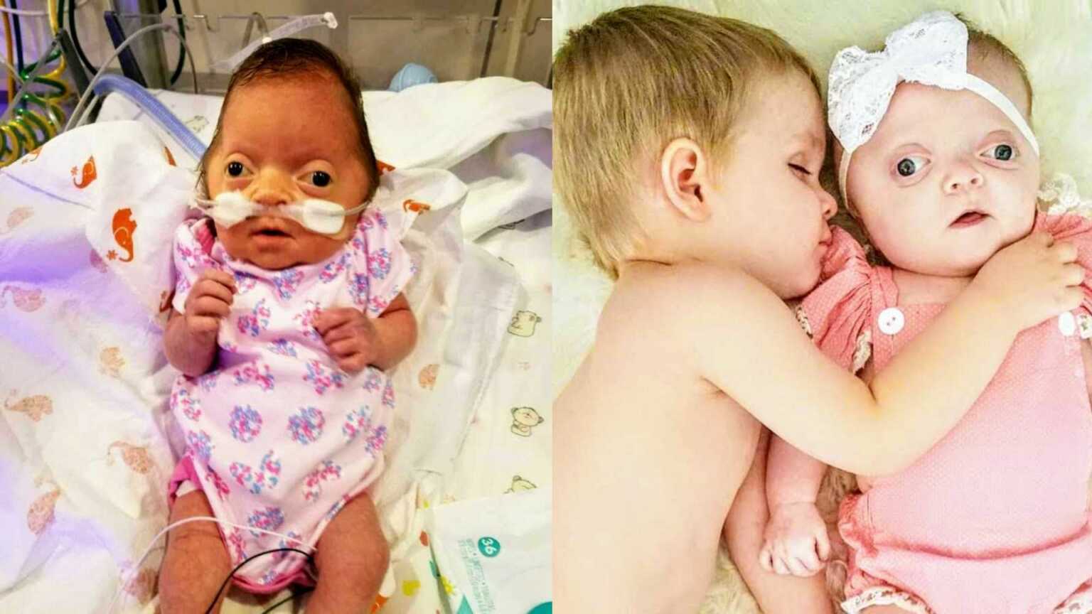 My Baby Was Born With Pfeiffer Syndrome, And I Wouldn’t Change Her ...