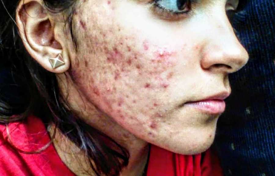 ‘How can your mom kiss you with that face?!’ My cysts were so bad they ...