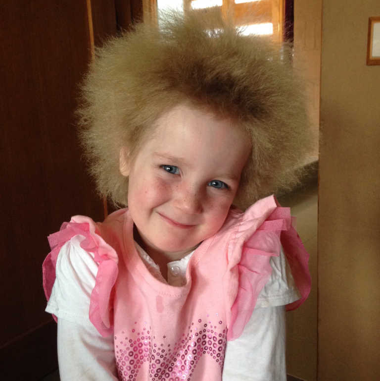 My Daughter Was Born With Uncombable Hair Syndrome (Yes, It’s A Real ...