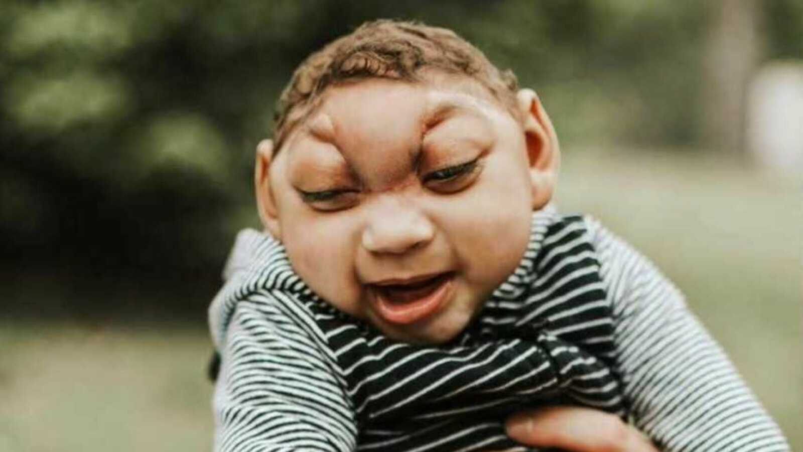 My Baby Was Born Without Most Of His Skull: The Journey Of A ...