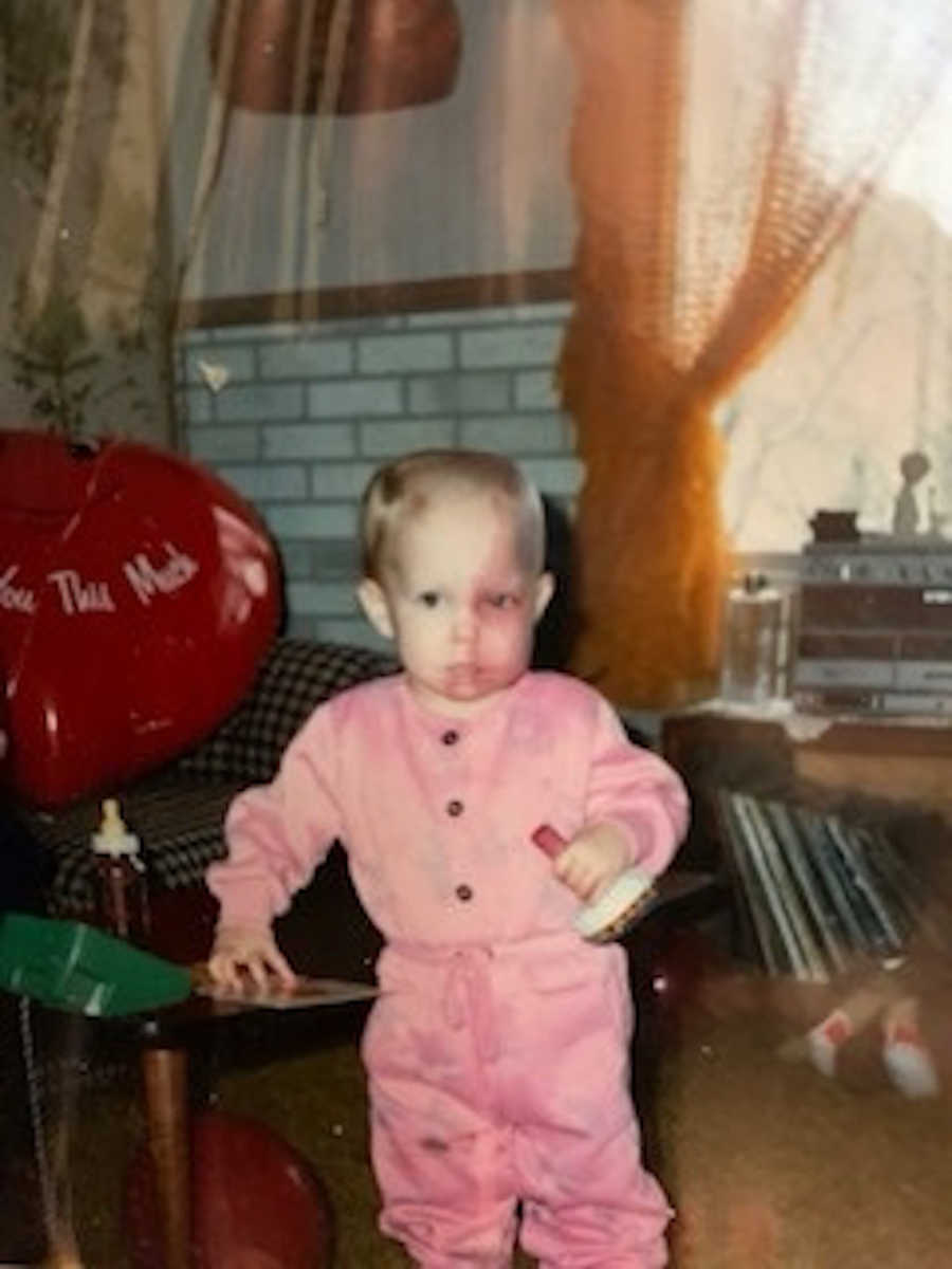 I Have A Facial Difference Called Sturge Weber Syndrome, And No I’m Not ...