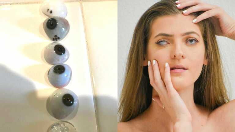 I Have A Rare Genetic Disorder Called Oculofaciocardiodental Syndrome ...