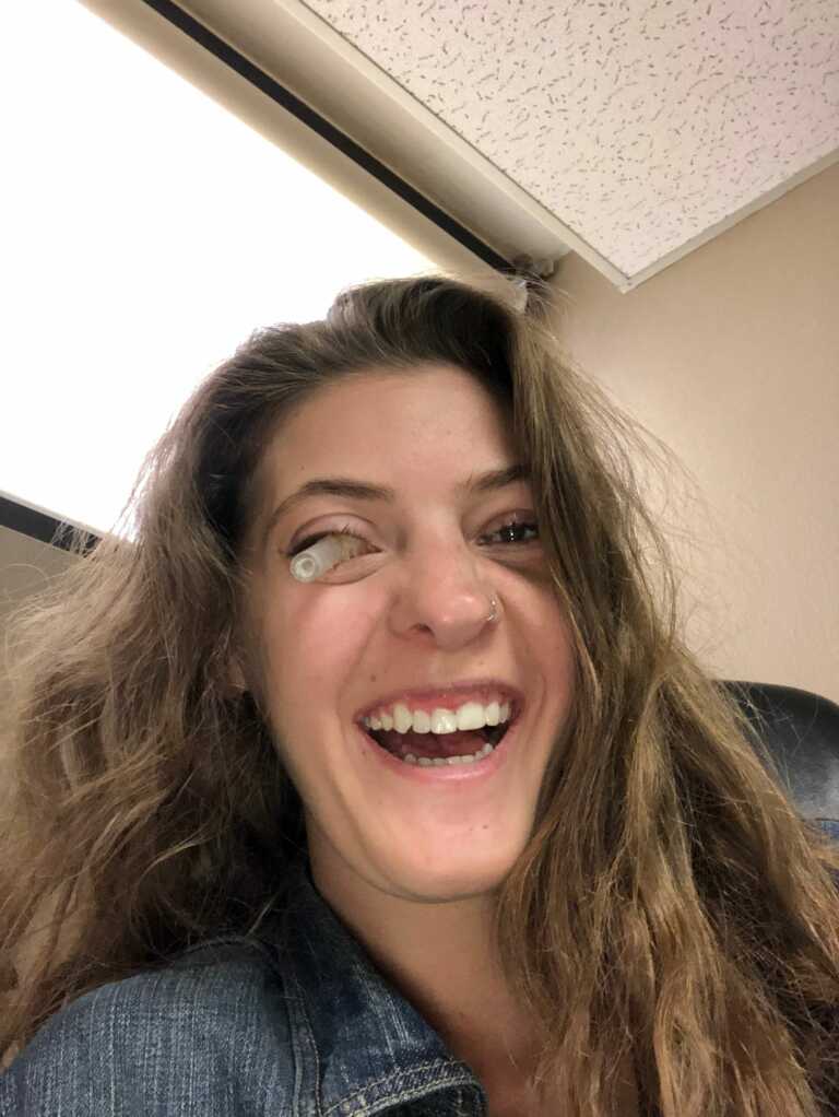 I Have A Rare Genetic Disorder Called Oculofaciocardiodental Syndrome ...