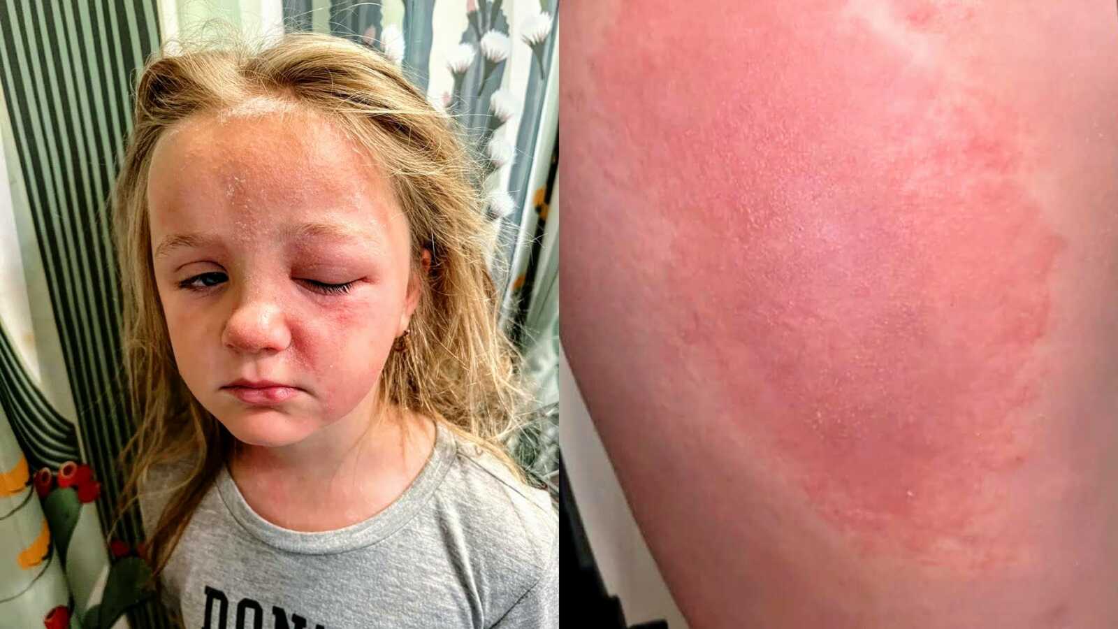‘It looks like a harmless weed.’: Mom warns of poison hemlock after ...