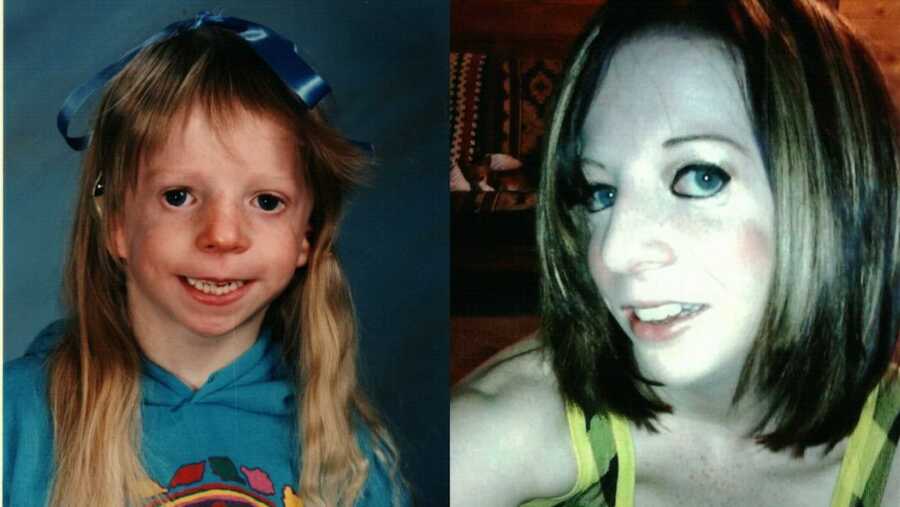 ‘I was benched and pushed to the side.’: Woman with Treacher Collins ...